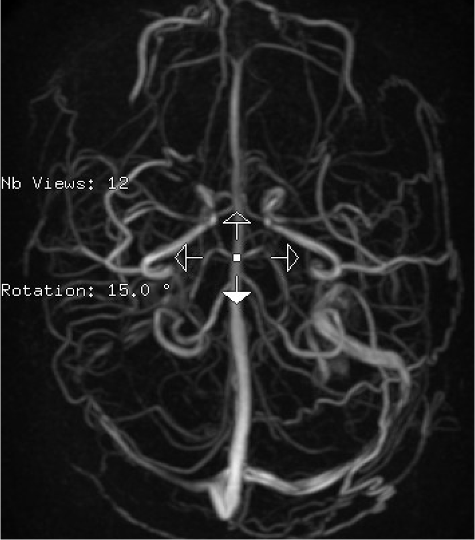 IIHTT clinical trial - Serenity Medical